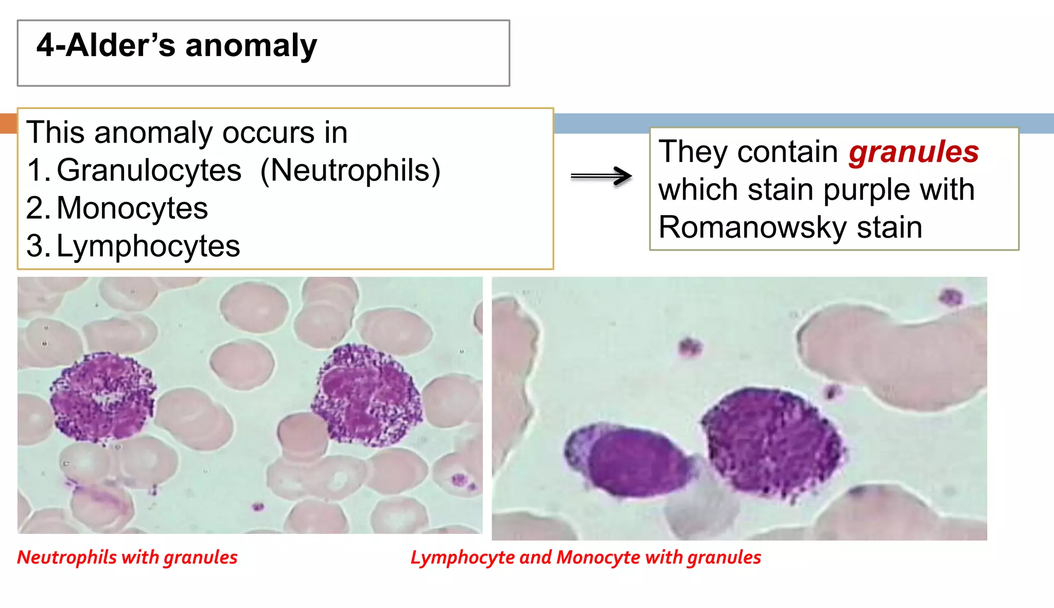 Qualitative defects of granular white cells.ppt