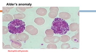 Qualitative defects of granular white cells.ppt