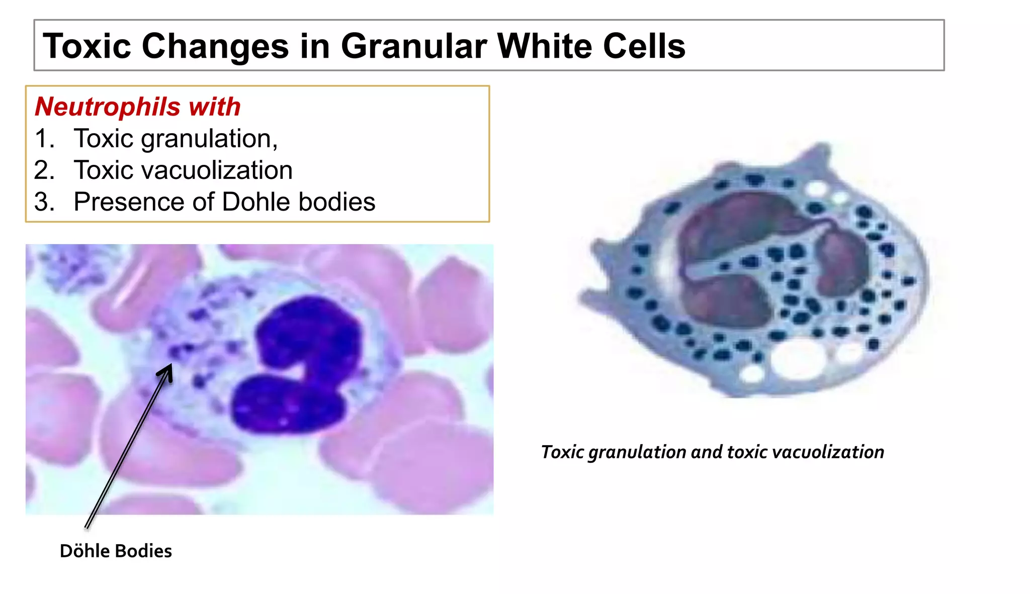Qualitative defects of granular white cells.ppt