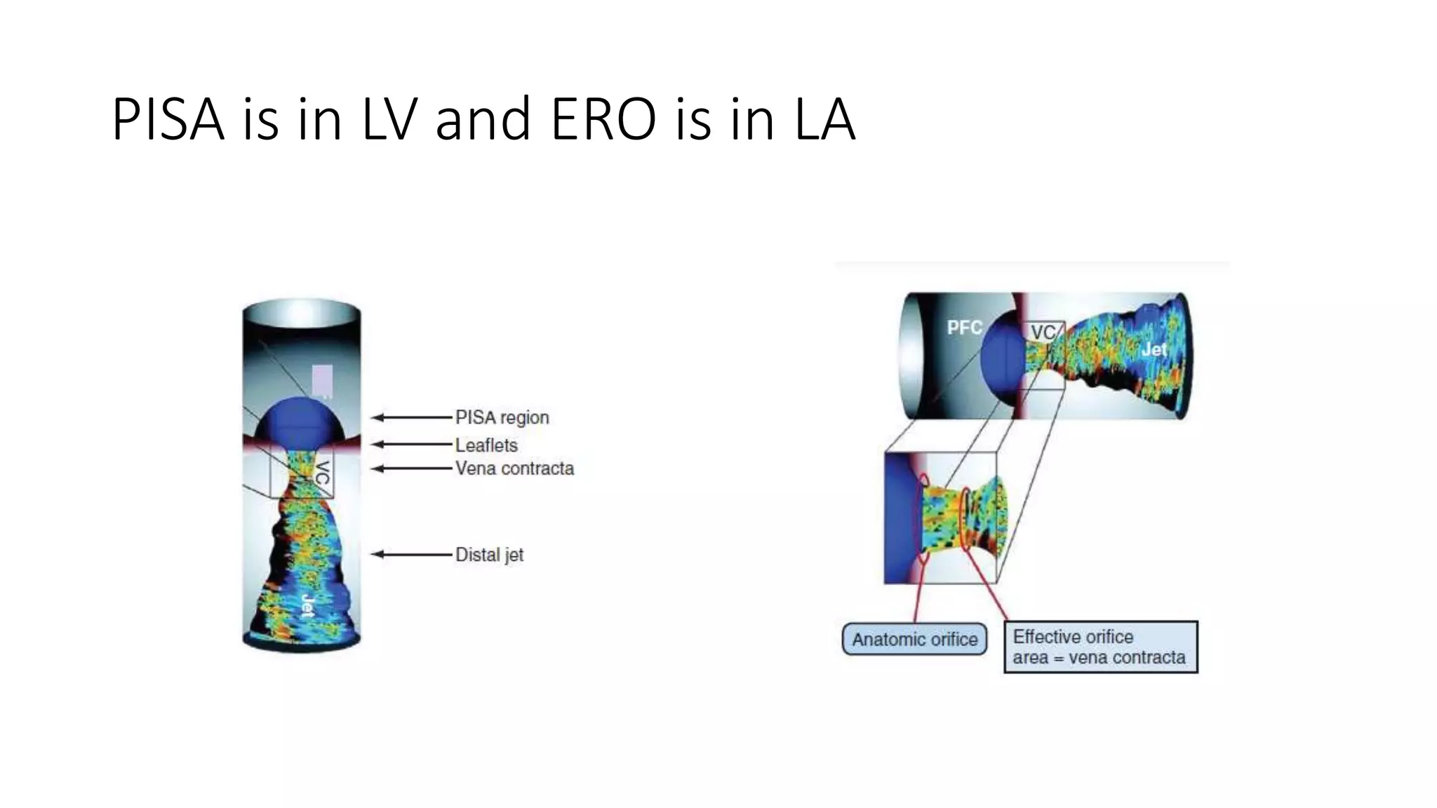 Quantification of mitral regurgitation by PISA | PPTX