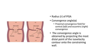Quantification of mitral regurgitation by PISA | PPTX
