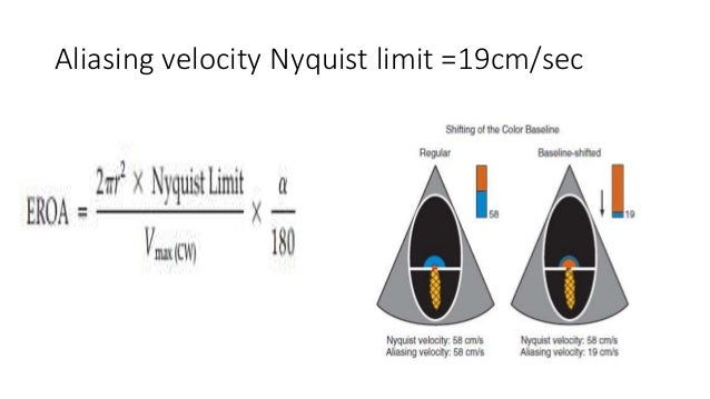 Quantification of mitral regurgitation by PISA