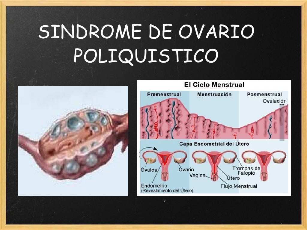Que Es El Sindrome Del Ovario Poliquistico