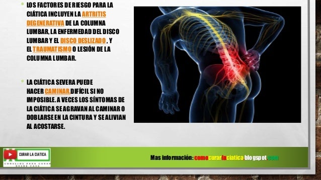 Que es la ciatica