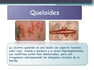 Queloides (1) (1) (1) | PPTX