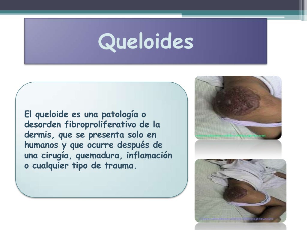 Queloides 1 1 1 Queloides 1 1 1