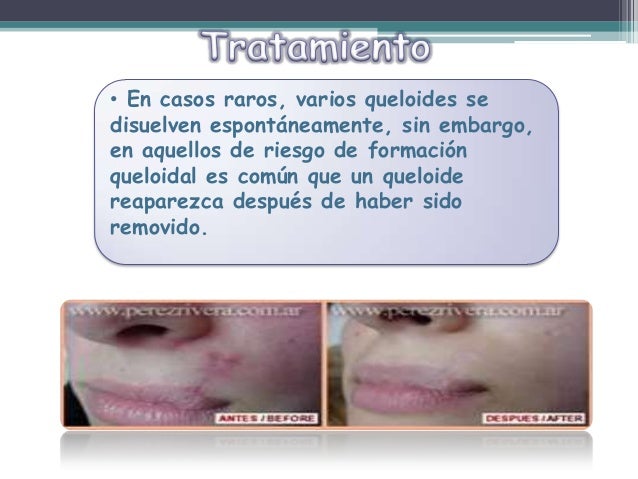 Queloides (1) (1) (1)