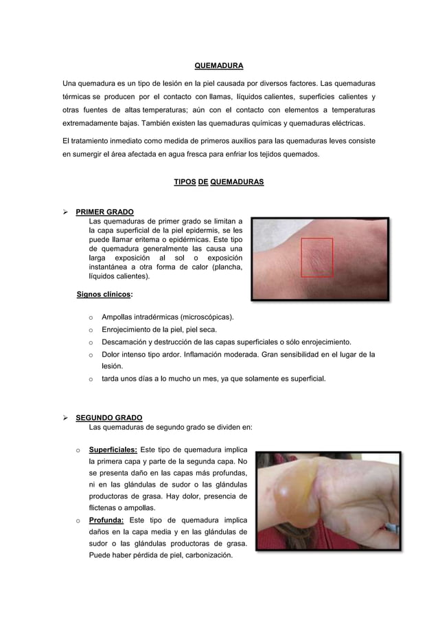 Quemadura | DOC