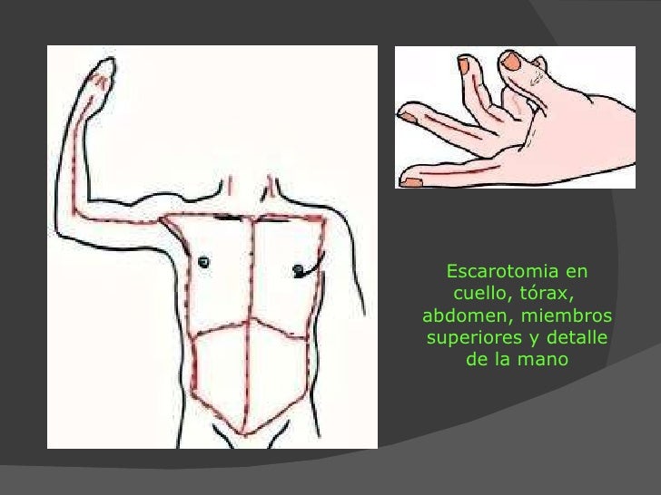 Quemaduras