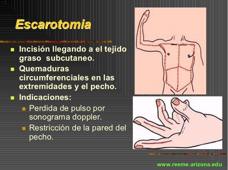Quemaduras