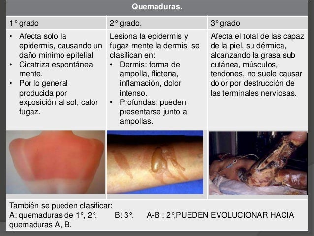 Quemaduras