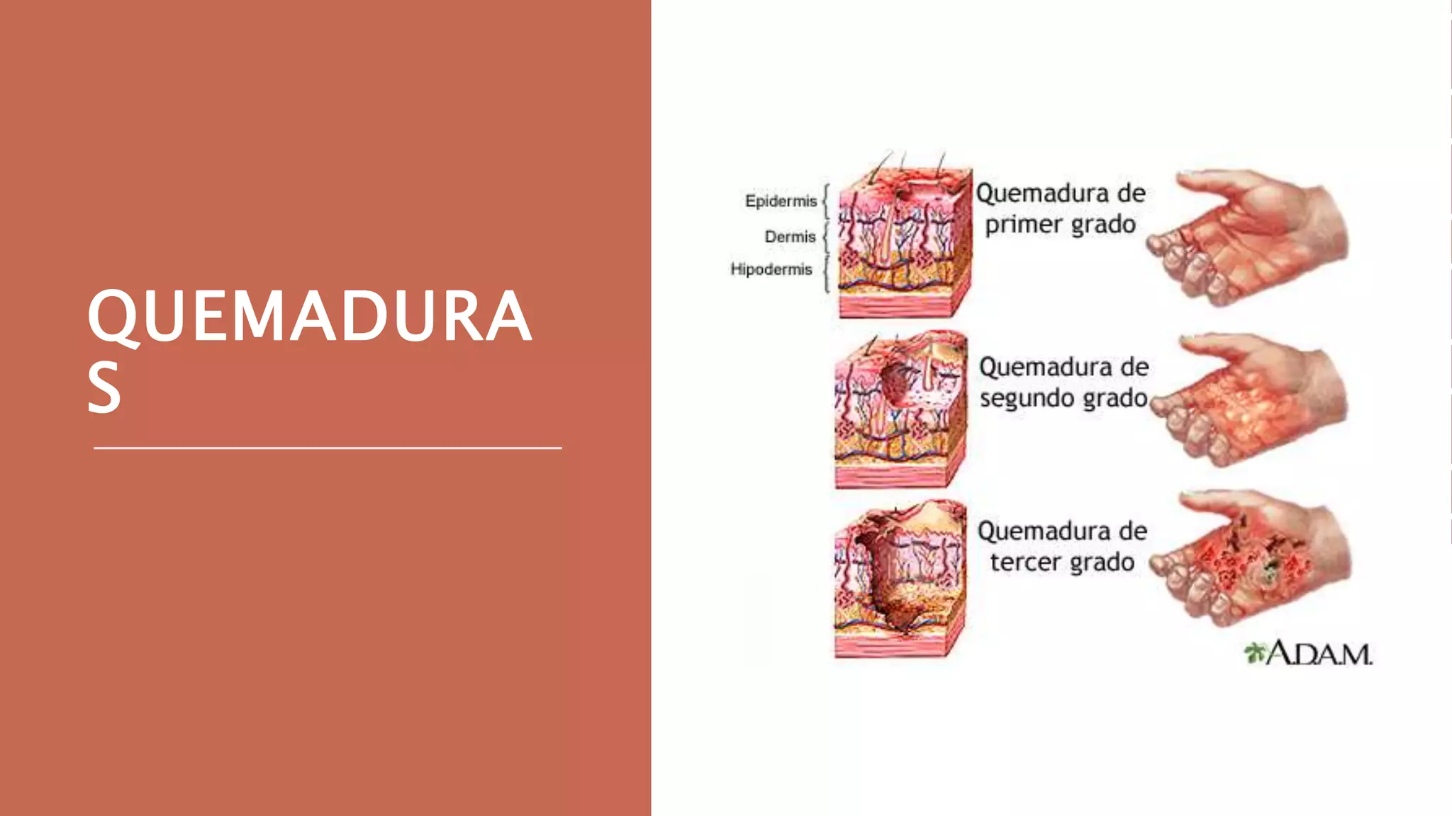 Quemaduras De 1er, 2do Y 3er Grado Grados De Las Quemaduras: