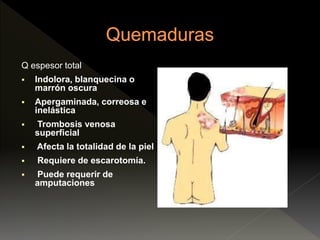QUEMADURAS.pptx