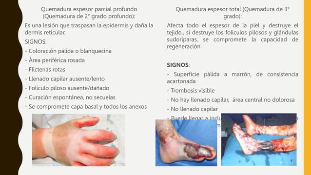 QUEMADURAS clasificación y manejo sintomático | PPTX | Skin and ...