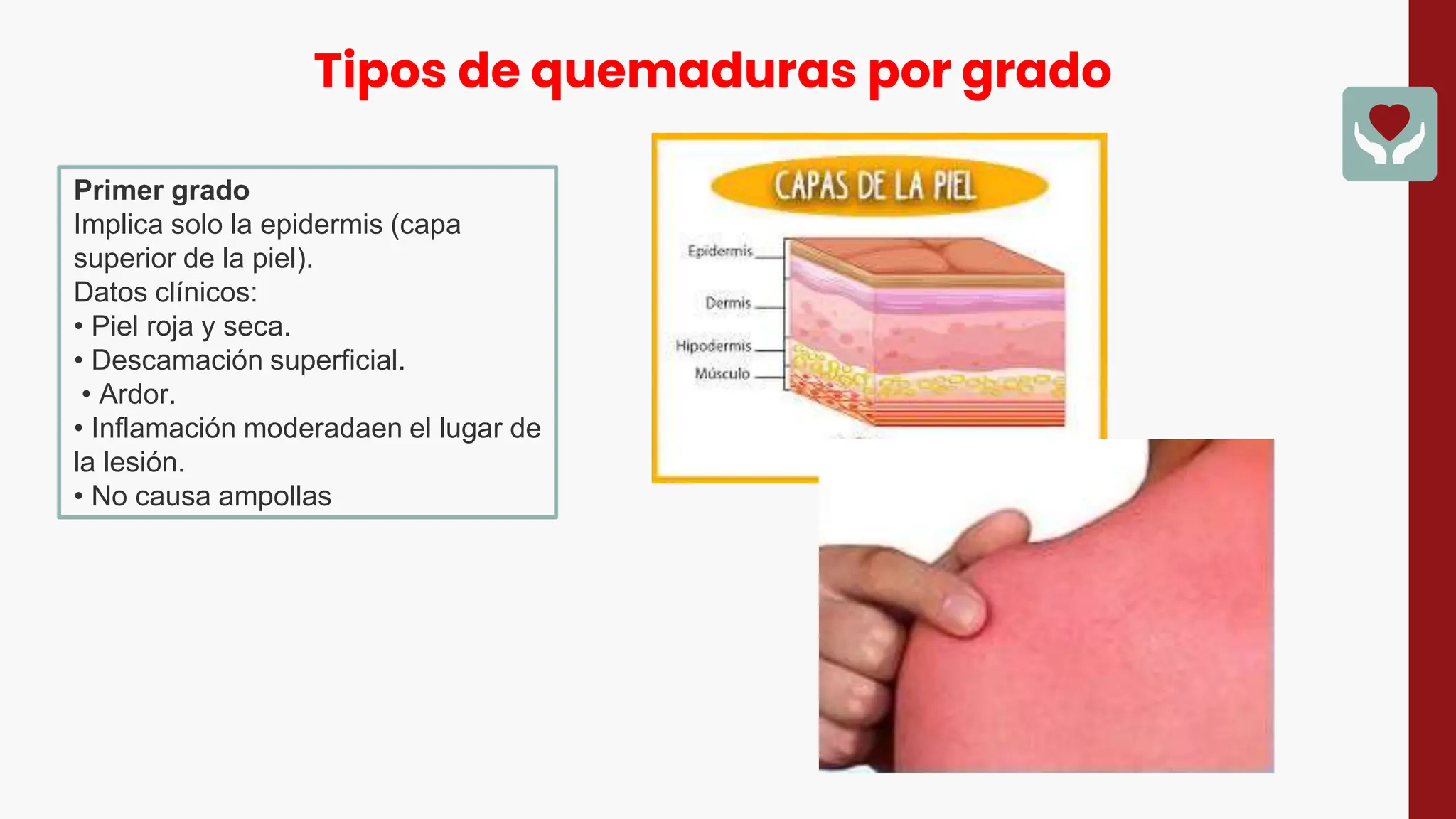 QUEMADURAS, primeros auxilios manejo.pptx