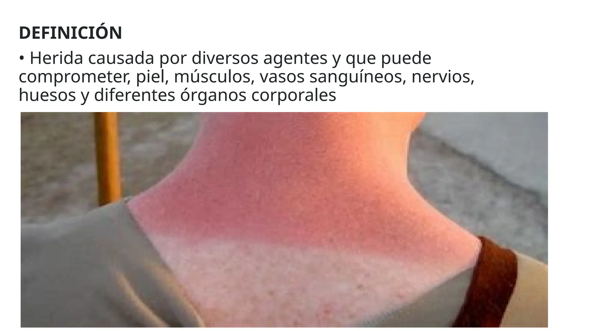 QUEMADURAS tipo de mas comunes para la practica clínica pptx | PPTX