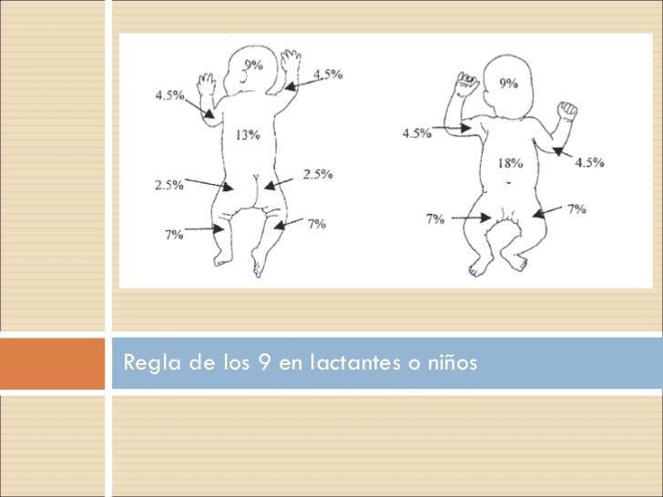 Escala De Los 9 Quemaduras – Regla De 9 Quemada – OAPHT
