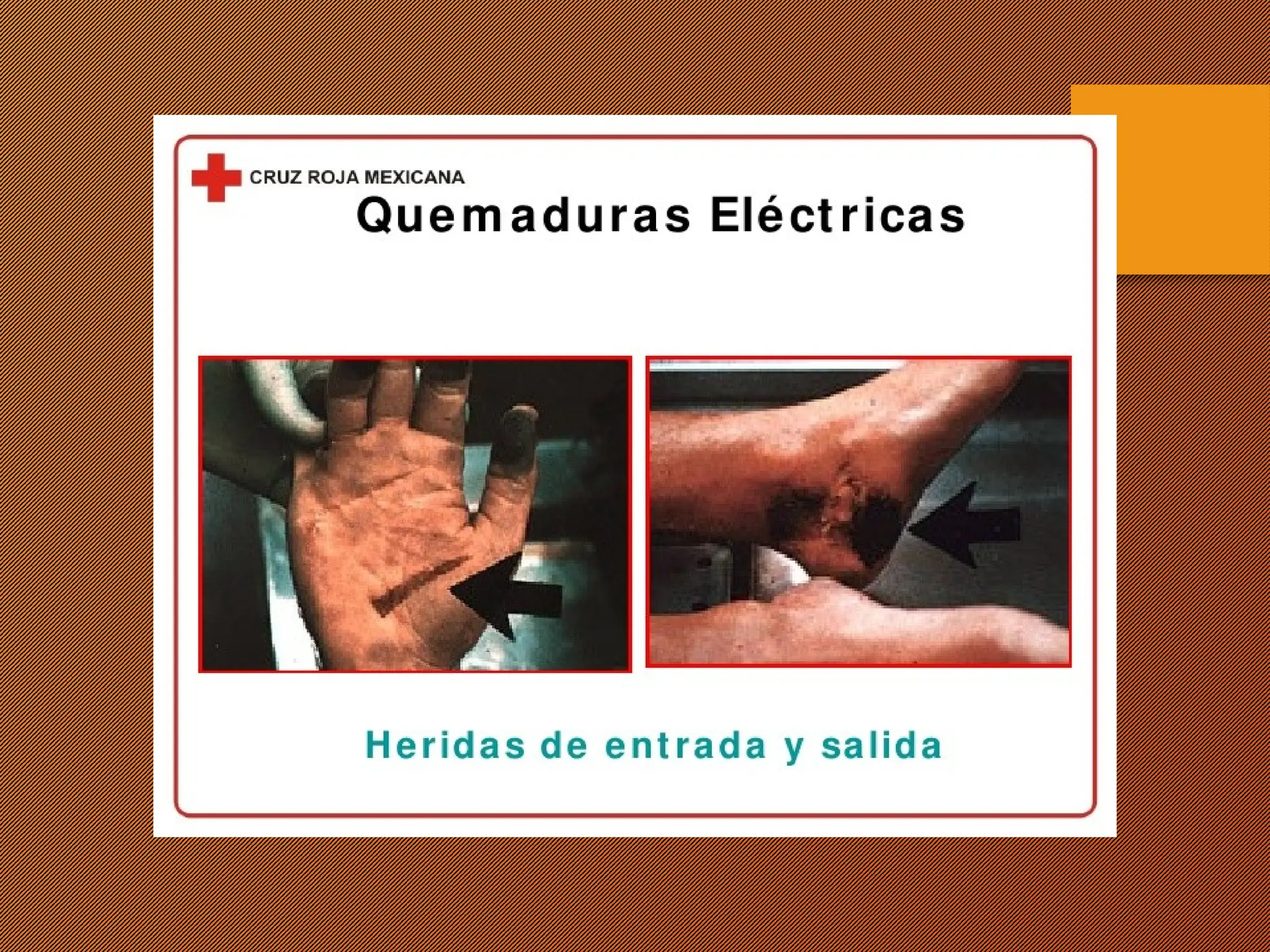 QUEMADURAS: que son, manejo, cuidados y tratamiento | PPT
