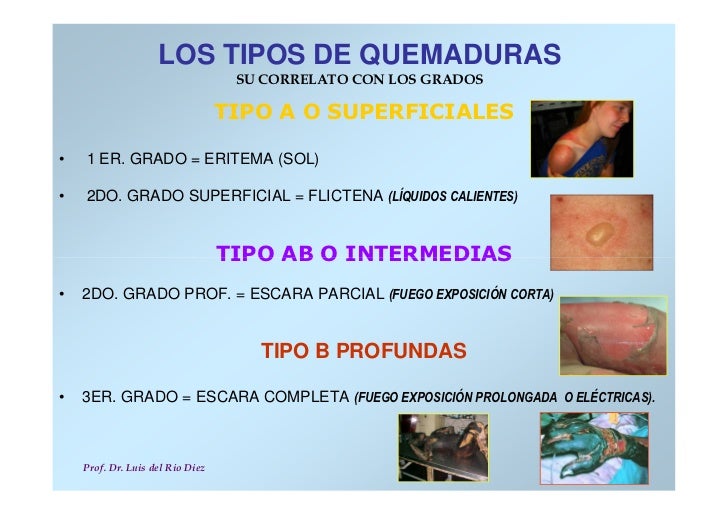 Clasificación Quemaduras Grados – VYJSBI