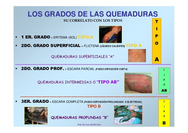 Clasificacion De Quemaduras Segun Su Profundidad – QJWBJX