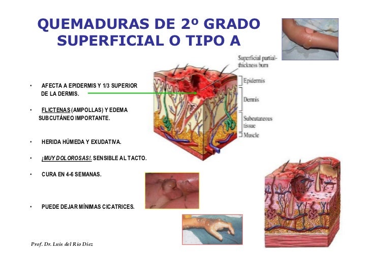 Quemaduras catedra de clinica quirurgica