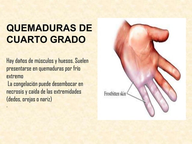 Quemaduras, clasificación y cuidados de enfermería | PPT