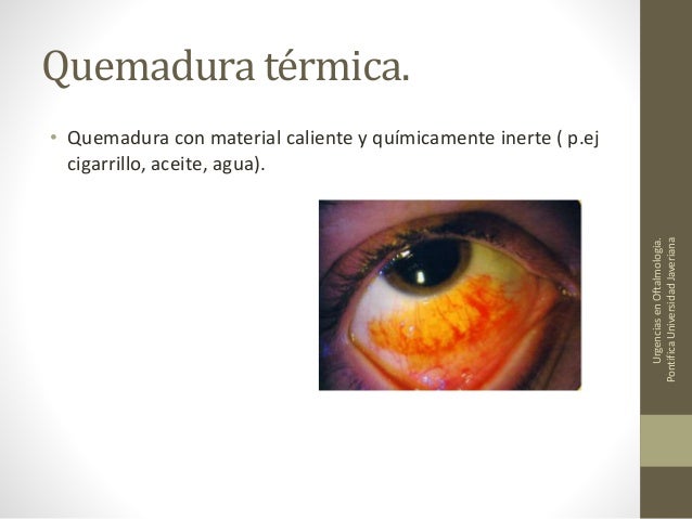 Quemaduras en oftalmología