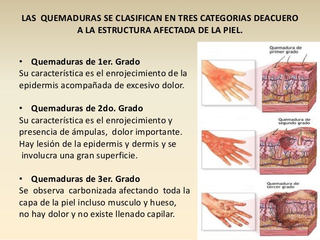 Quemaduras presentacion