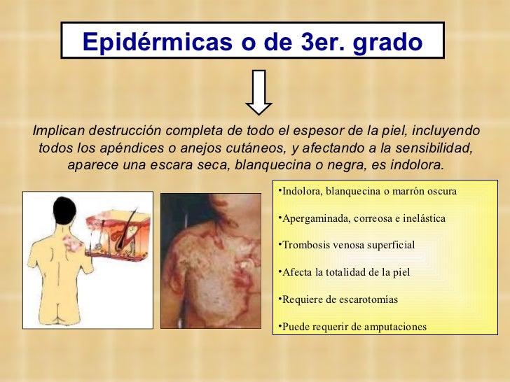 Tercer Grado Quemaduras at Melinda Morris blog