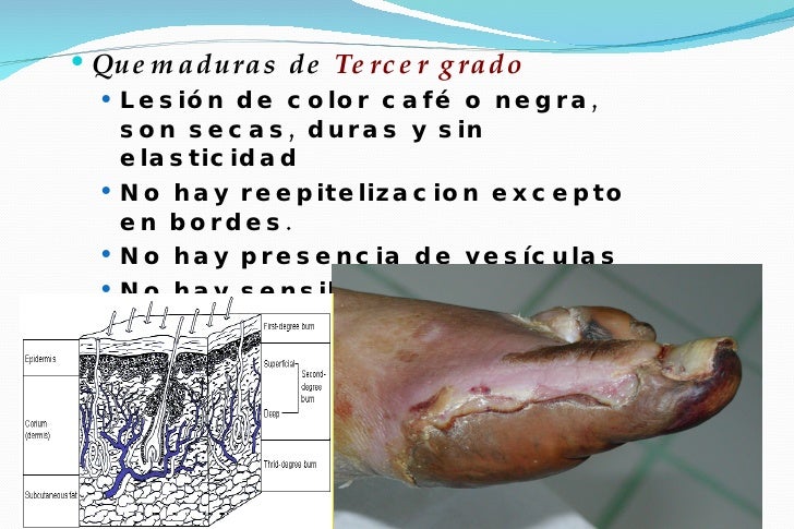 Quemaduras Termicas Electricas Frio Quimicas