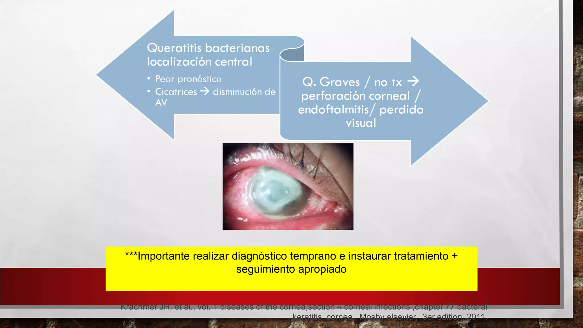 Queratitis bacteriana | PDF