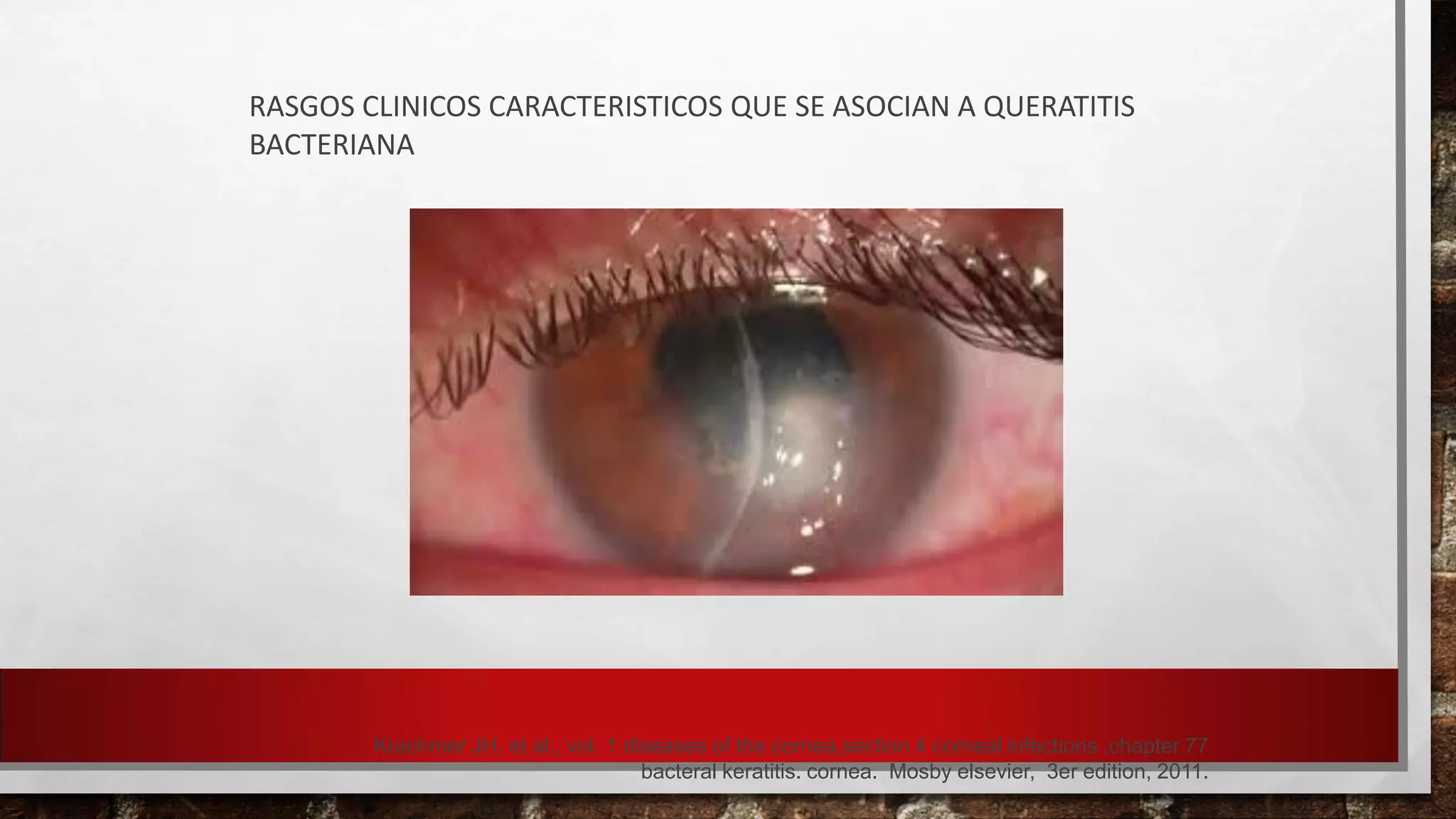 Queratitis bacteriana | PDF