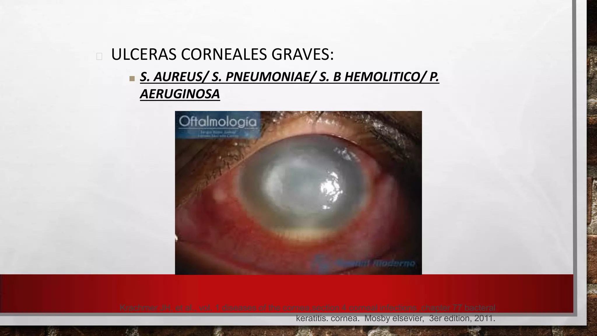 Queratitis bacteriana | PDF