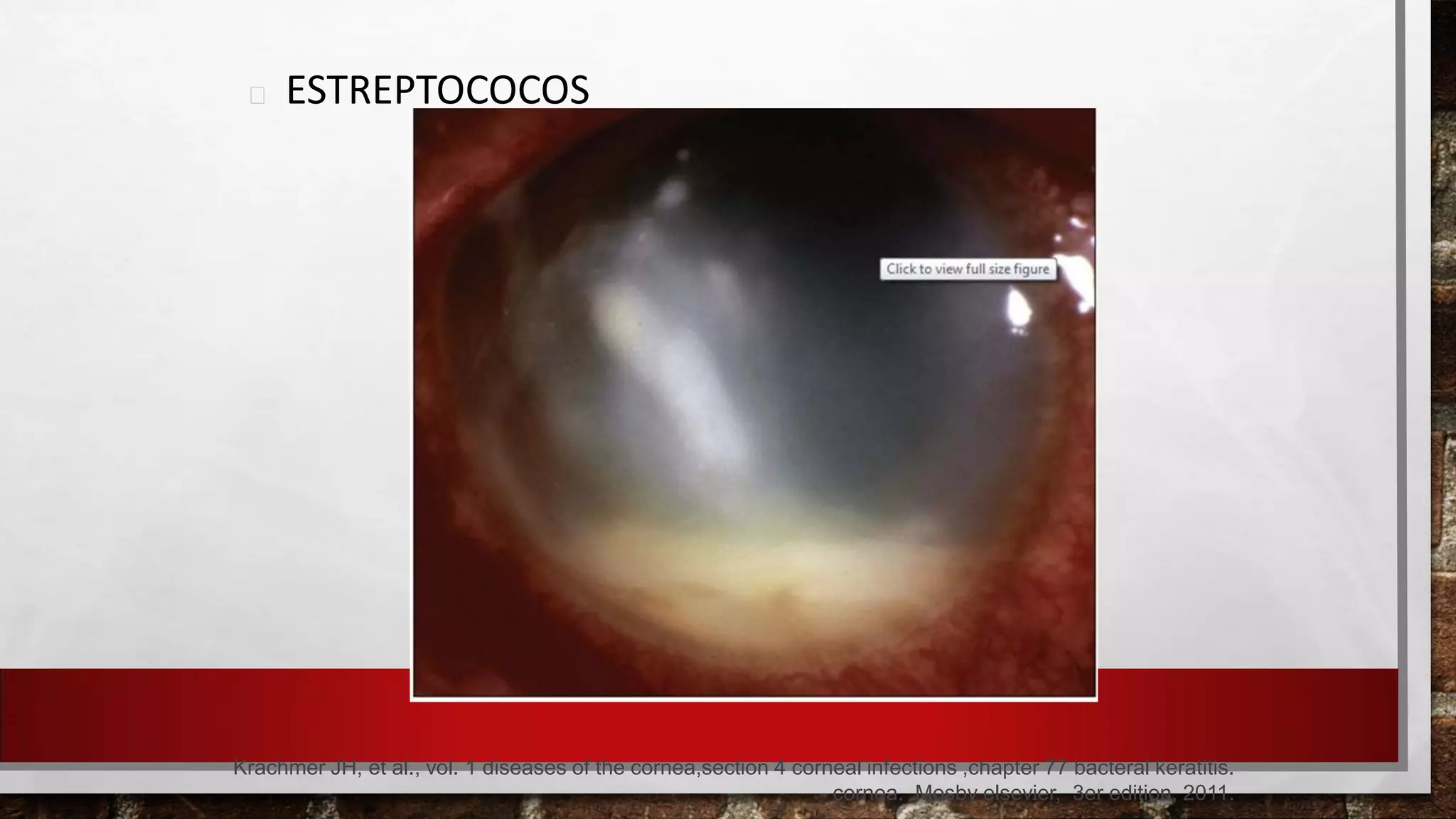 Queratitis bacteriana | PDF