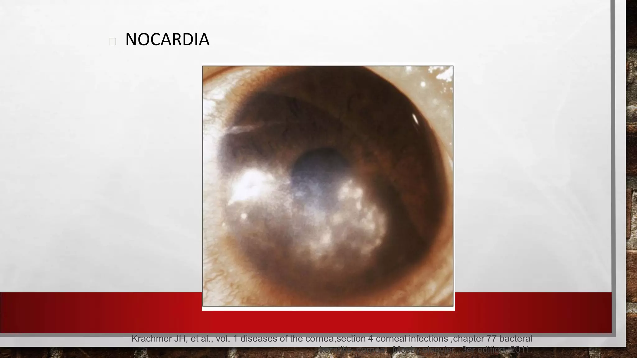 Queratitis bacteriana | PDF