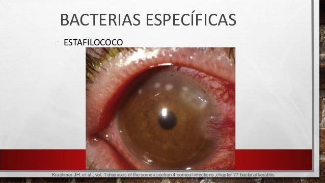 Queratitis bacteriana