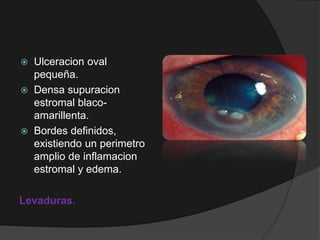Queratitis micotica | PPTX