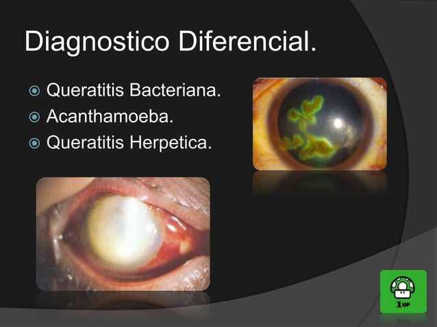 Queratitis micotica | PPTX