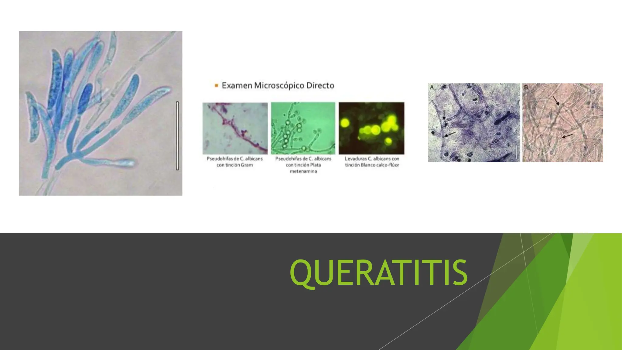 Queratitis micotica-manejo | PPTX