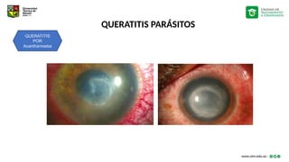 QUERATITIS MICÓTICAS PATRICIA DURAN OSPINA.pptx