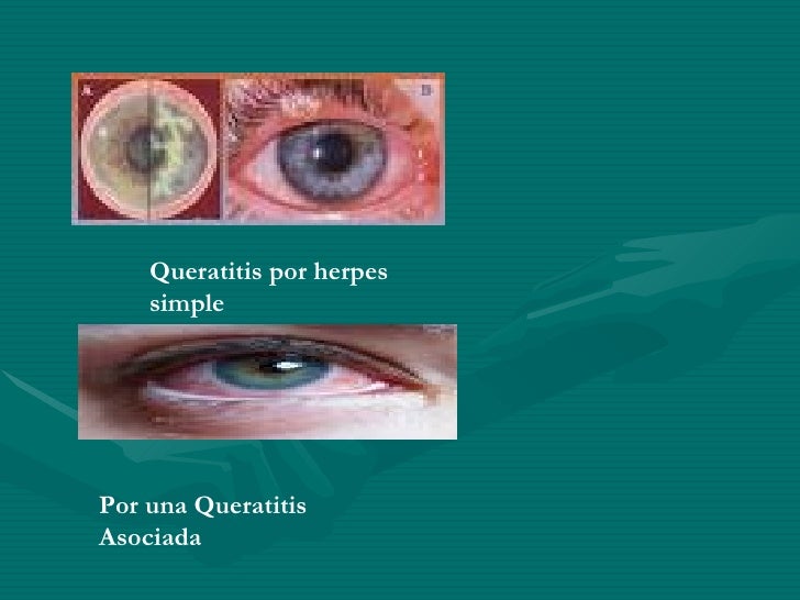 Queratitis Viral