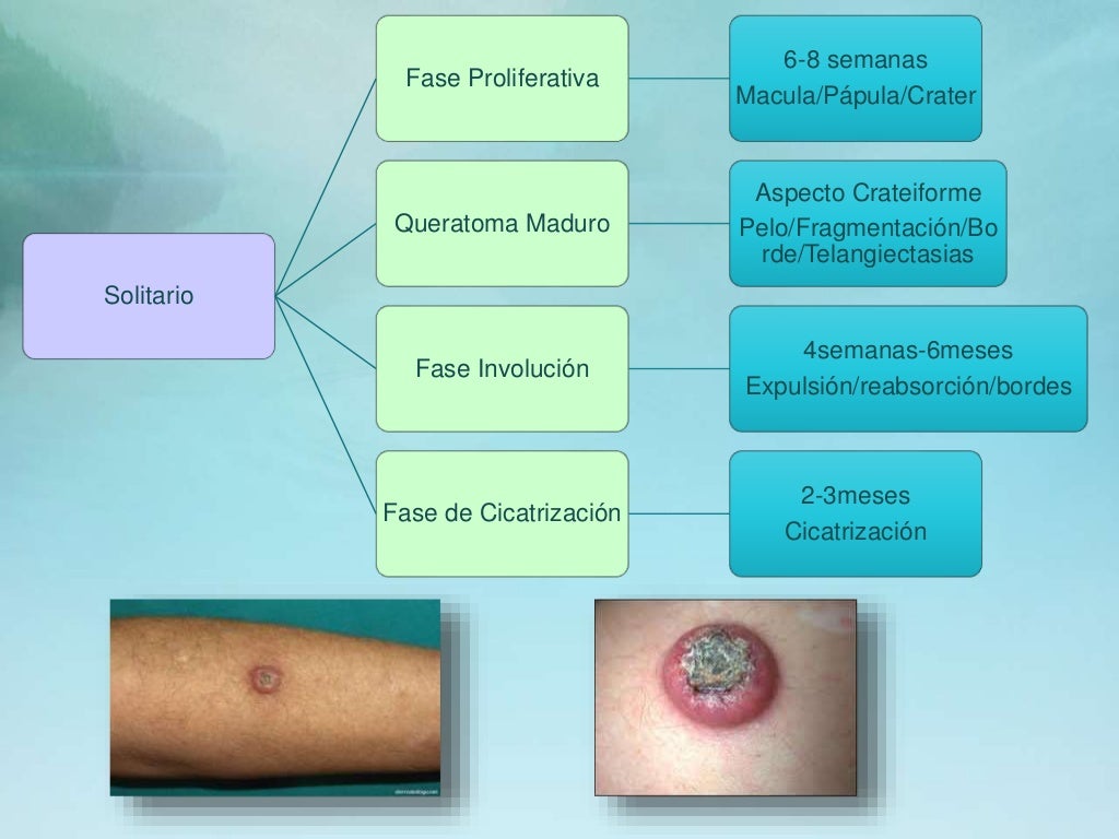 Queratoacantoma Dermatologia