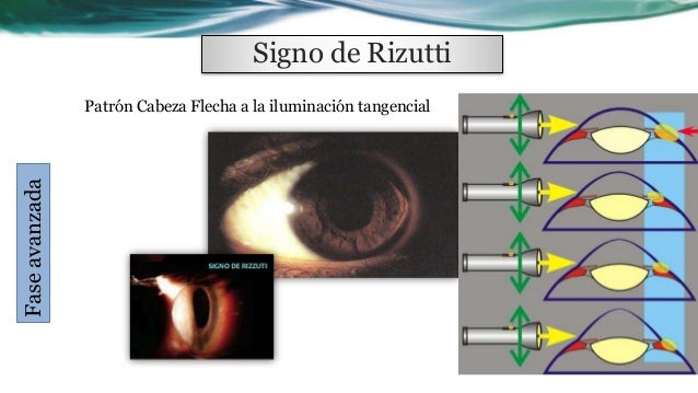 Queratocono lml