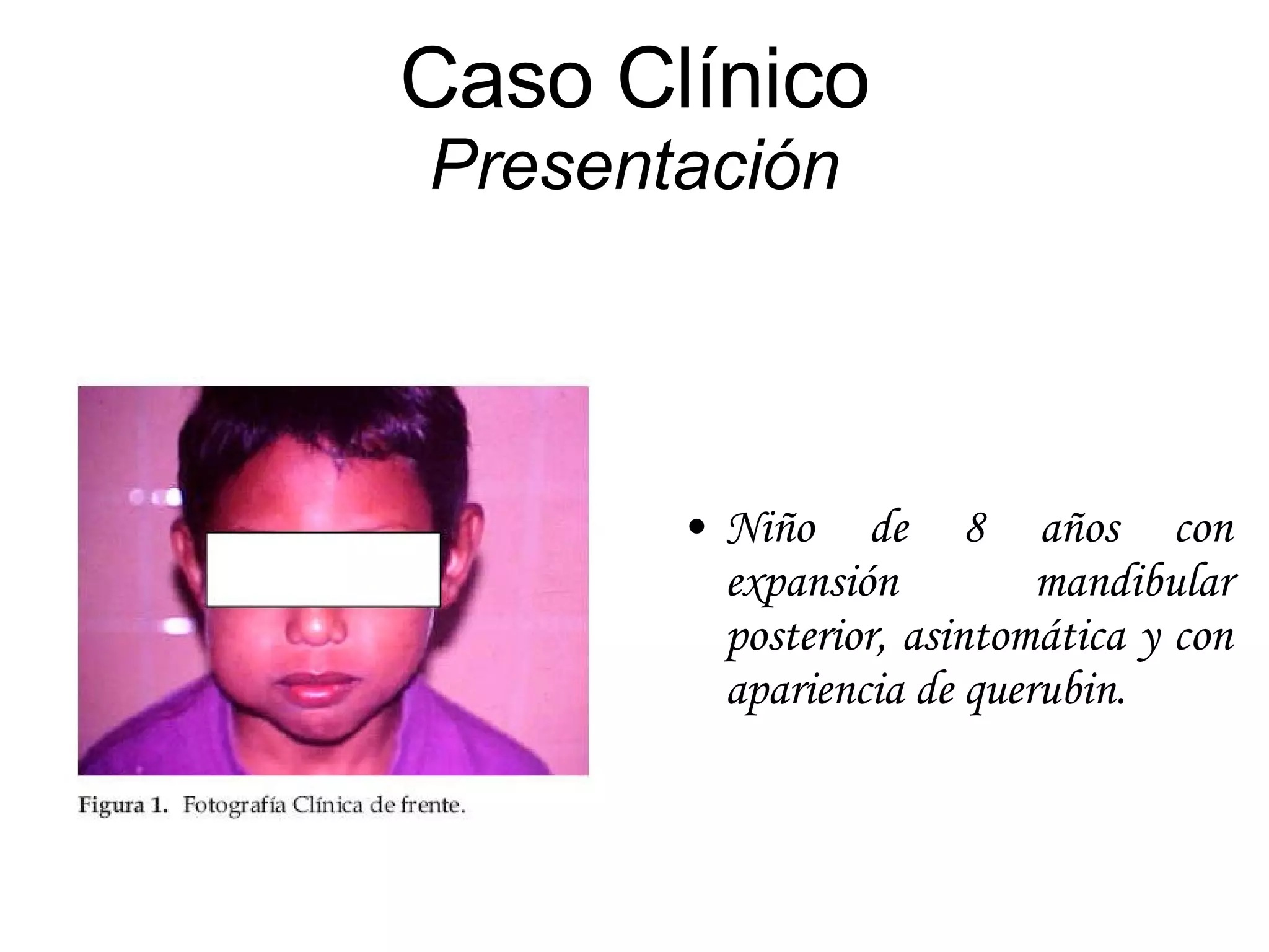 Querubismo Presentacion | PPT