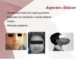 Querubismo revisado | PPTX