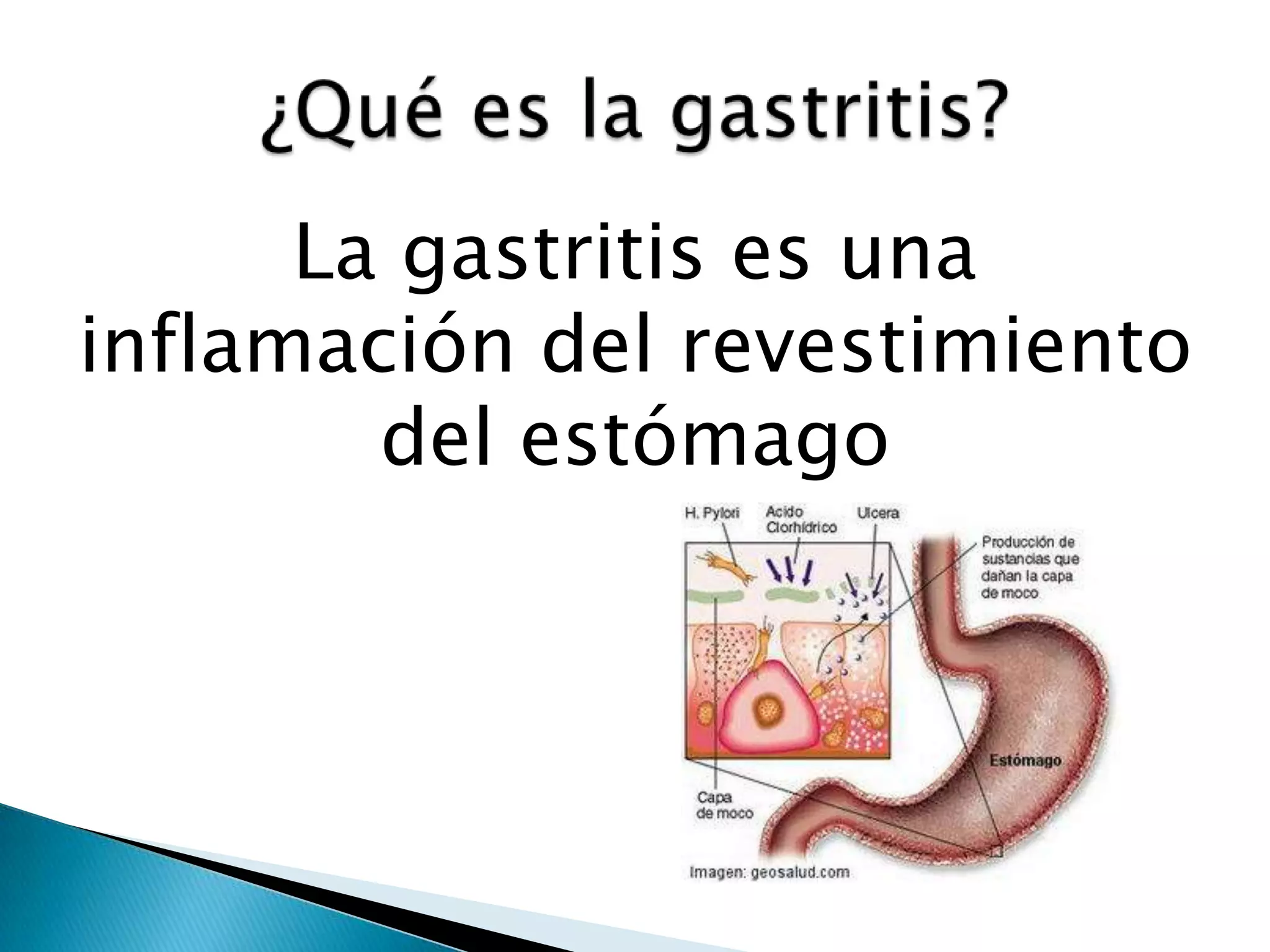Qué es la gastritis | PPT
