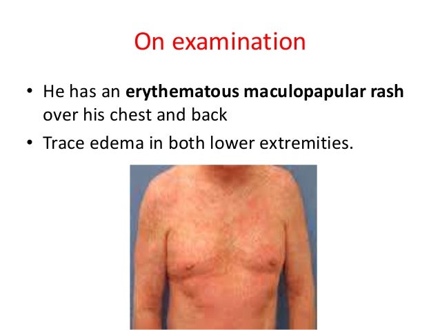 Maculopapular Rash On Chest