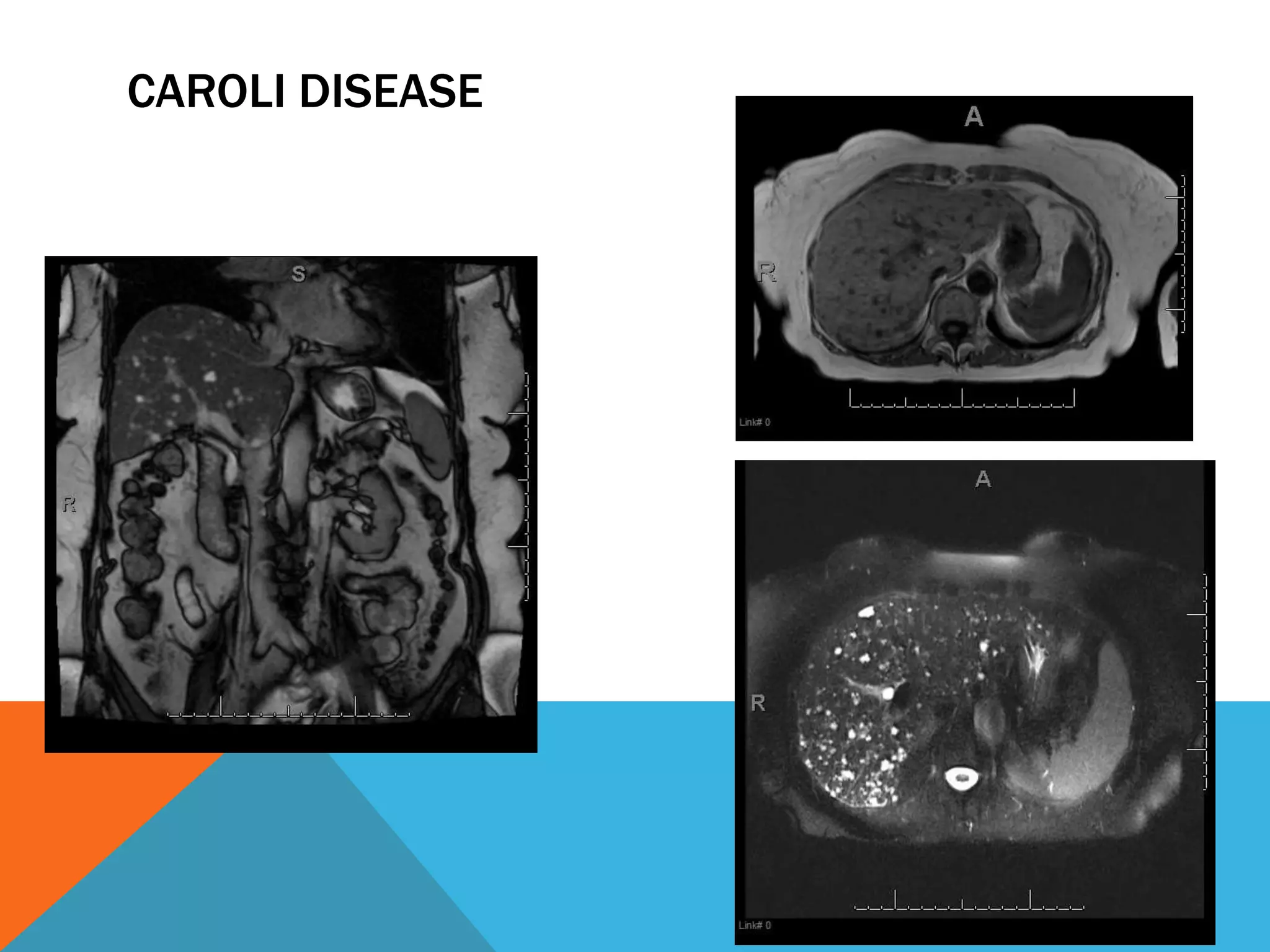 Quick review of hepatobiliary and pancreatic lesion | PPTX
