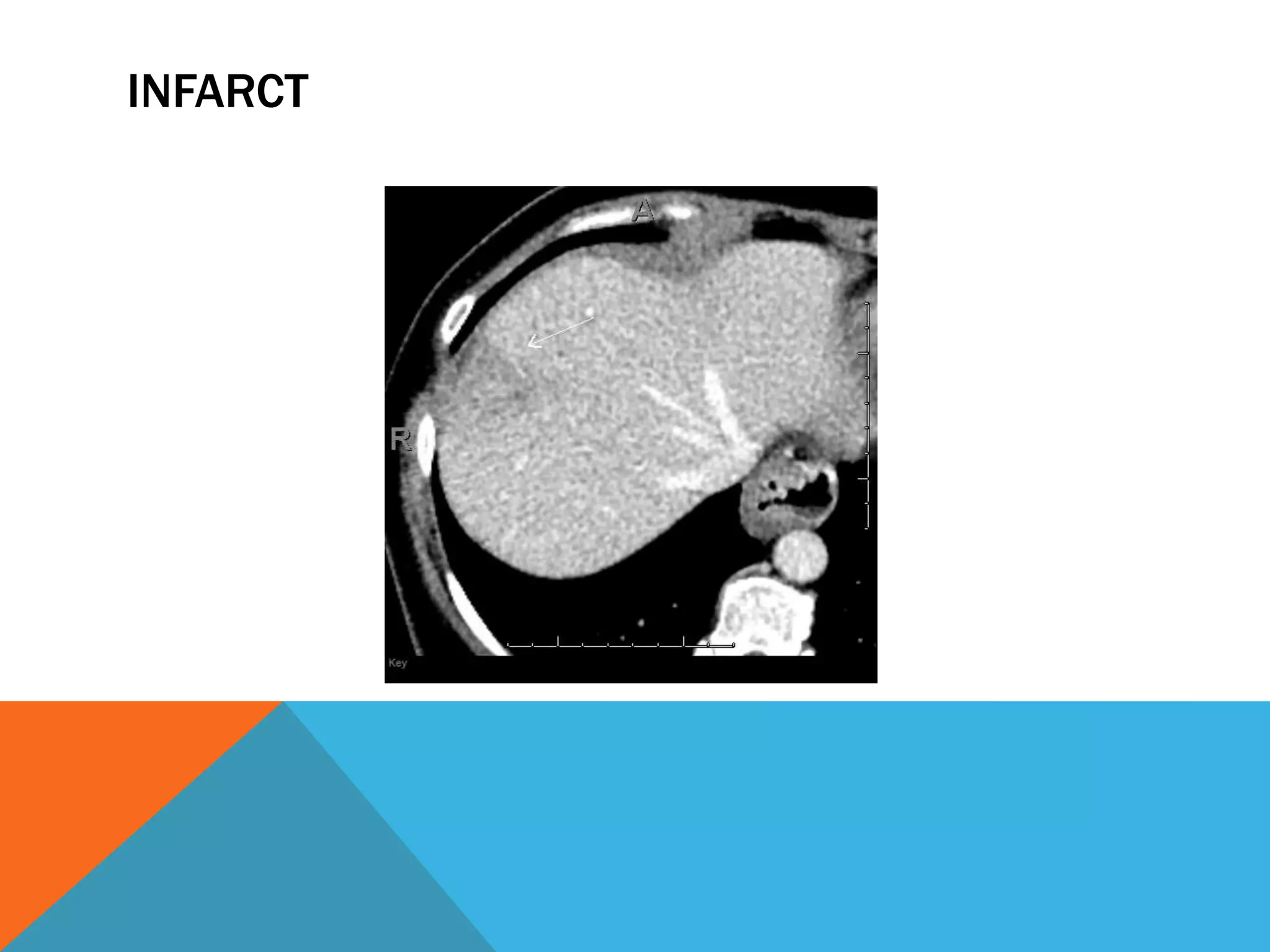 Quick review of hepatobiliary and pancreatic lesion | PPTX