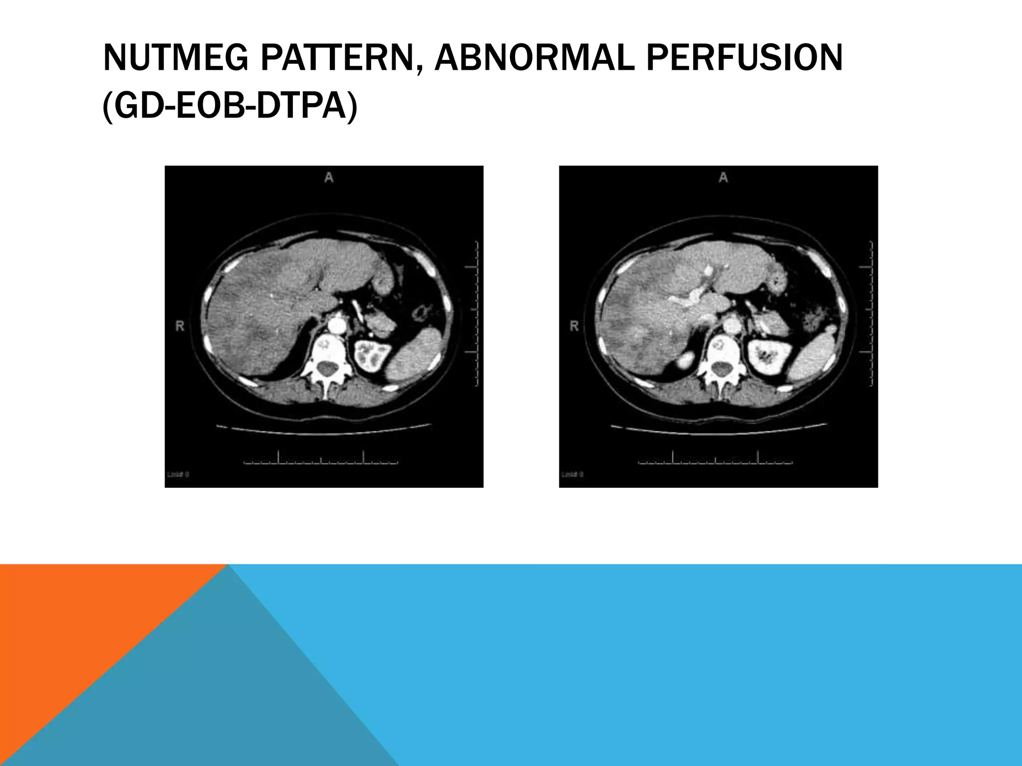 Quick review of hepatobiliary and pancreatic lesion | PPTX